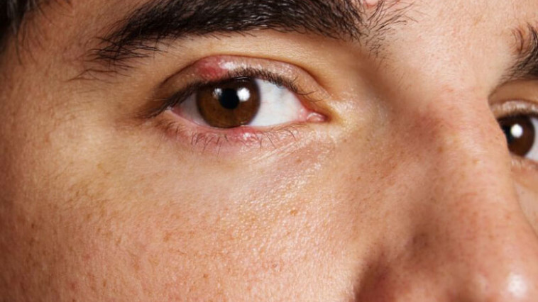 Ano ang Gamot sa Tulo? | Sakitpedya